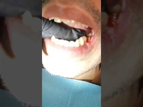 Proses Pencabutan Sisa Akar Gigi Geraham Bawah YouTube