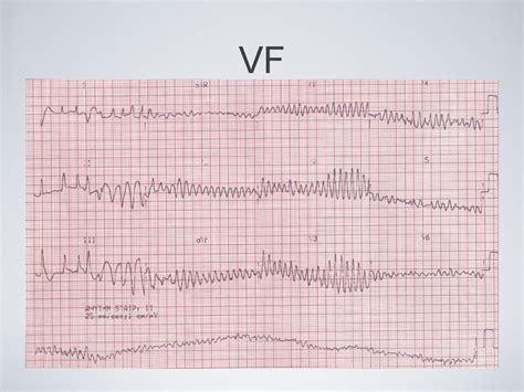 Recognizing Cardiac Arrhythmias Normal Anatomy Normal ECG Normal