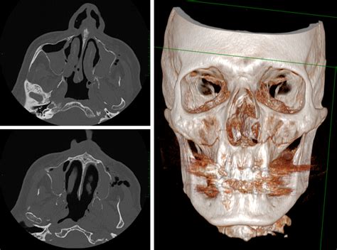 Lefort Fracture