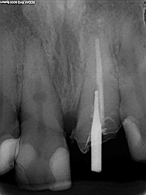 Reabsorciones Radiculares Nina Camborda Endodoncista