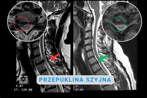 Jak rehabilitować przepuklinę szyjną kręgosłupa Rehmedis pl