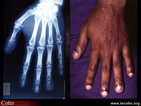 Sarcoïdose osseuse Diapothèque du COFER