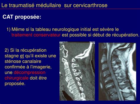 PPT Les traumatismes vertèbro médullaires PowerPoint Presentation
