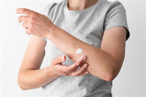 O que é dermatite atópica Causas sintomas e tratamentos eficazes