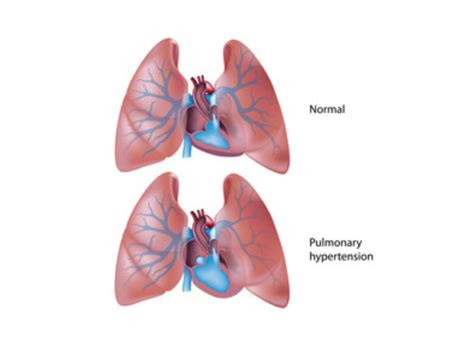 What Is Pulmonary Embolectomy Procedure Dr C Raghu