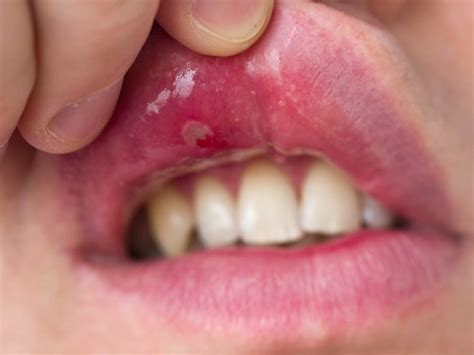 männlich Vitalität Teilweise manchas blancas en las amigdalas sin dolor