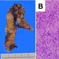 Pathological Findings A Macroscopic Specimen Of The Resected Tumors B