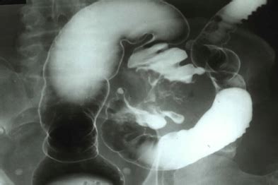 Clinical Review Large Bowel Obstruction GPonline