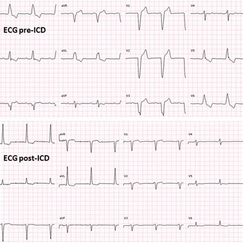 Electrocardiogram Before And After ICD Implantation With Left Bundle