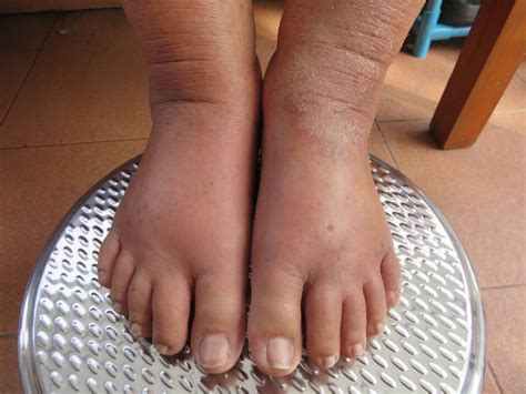 Por qué se hinchan los pies UNAM Global