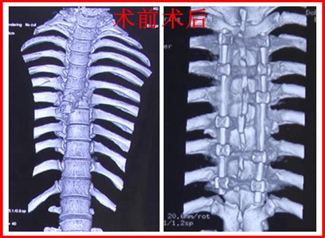 脊柱骨折治疗选择与微创理念 微医挂号网