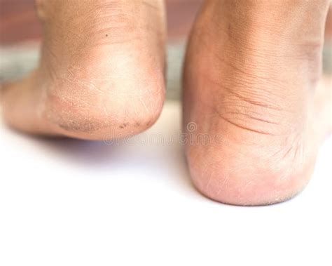 Fermez Vous Vers Le Haut Du Pied Sale Sur Le Fond Blanc Image Stock
