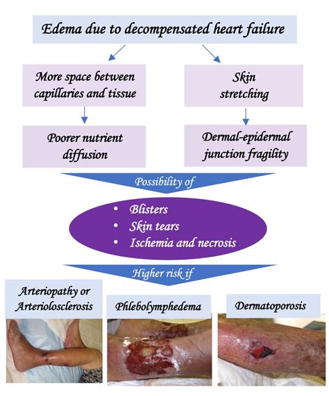 Leg Ulcers Due To Heart Failure Elena Conde