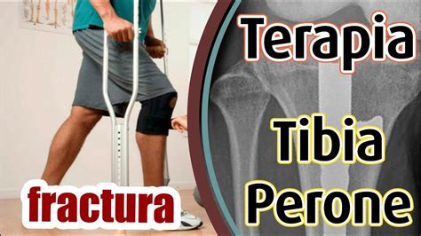 Terapia Fractura Tibia Y Perone Ejercicios Rehabilitacion YouTube
