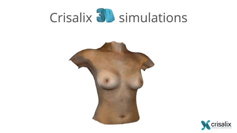 Crisalix 3D Simulations YouTube