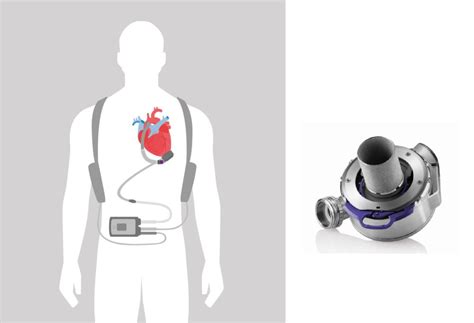 Left Ventricular Assist Device And How It Works The Heart Vascular