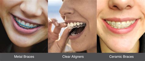 Types Of Braces Sample Orthodontics Dr Ericka Sample Dds