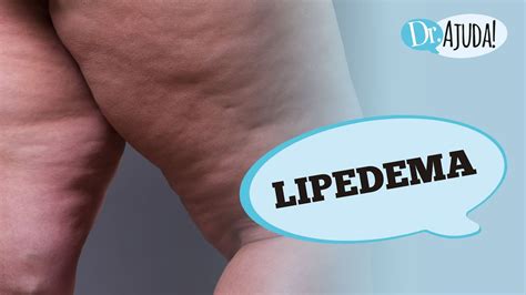 Lipedema saiba o que é e como tratar os principais sintomas da