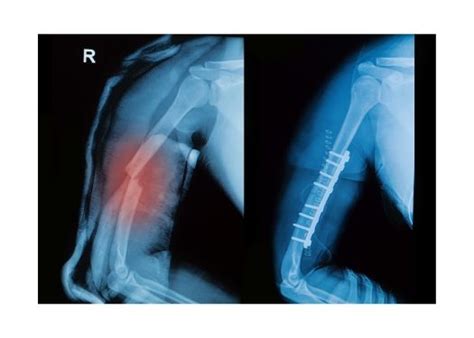 Humeral Shaft Fracture Fixation Shoulder Surgeon South Windsor