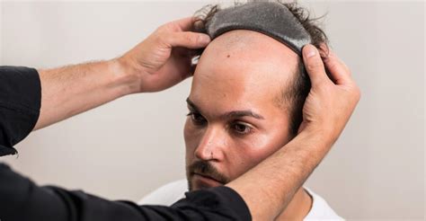 Descubre las prótesis capilares para hombres la solución a la alopecia