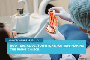 Root Canal Vs Tooth Extraction Making The Right Choice Township Dental