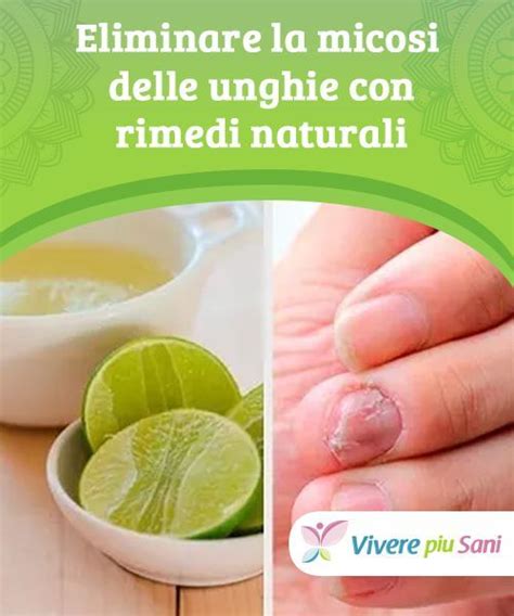 Eliminare La Micosi Delle Unghie Con Rimedi Naturali Per Eliminare La
