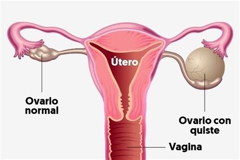 Quistes en los ovarios síntomas por qué salen tipos y tratamiento