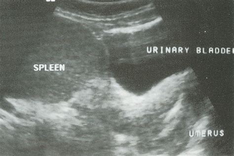 Spleen Ultrasound Flashcards Quizlet