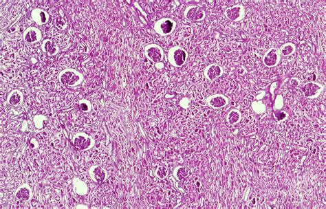 Diffuse Proliferative Glomerulonephritis Photograph By Nigel Downer