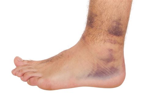 Ankle Fracture Dr David Geier Sports Medicine Simplified