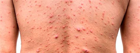Hiv Symptoms Rash Looks Like Infoupdate Org