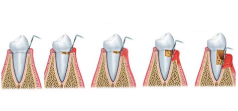 Periodontitis Qu Es Causas Y Tratamiento Ferrus Bratos