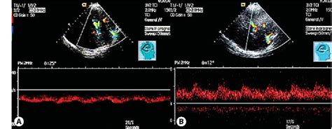 Figure 2 From Carotid And Transcranial Color Coded Duplex