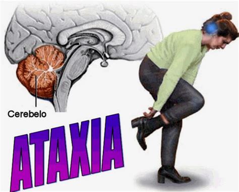 Ataxia Sintomas Causas E Tratamento