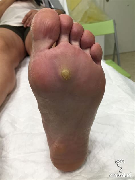 Qué tengo en el pie un callo o un papiloma Parte I Clinisalud