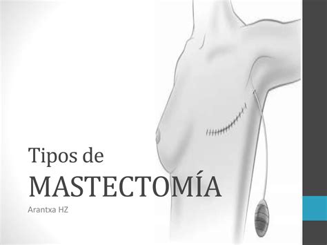 TIPOS DE MASTECTOMÍA PPT