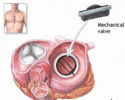 Benefits And Risks Of Heart Valve Replacement Surgery Vinmec