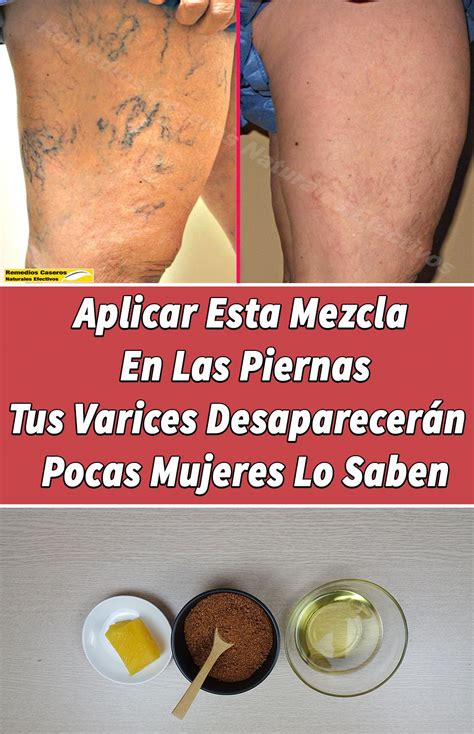 Pin En Remedios Caseros Para Las Varices