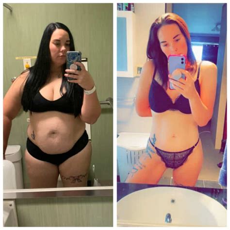 Gastric Sleeve Before And After Months