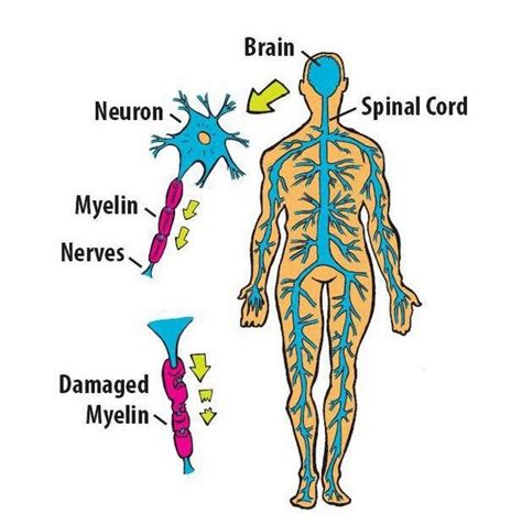 How Multiple Sclerosis Affects The Body Prince George Citizen