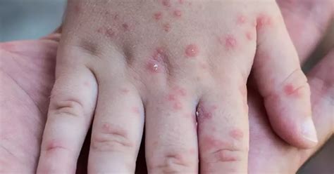 Minsa cuáles son las 4 regiones en alerta epidemiológica por brotes