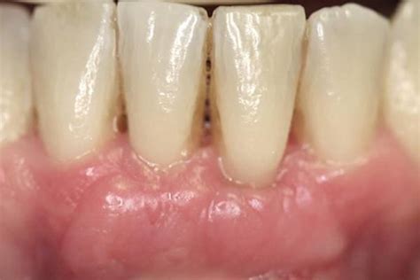 Gum Grafting Huntington Beach Cosmetic Periodontics Dr Braga