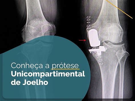 Conheça a prótese unicompartimental de joelho