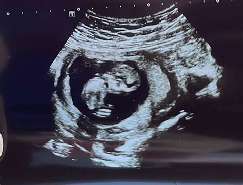 Week Ultrasound Gender Guess June Babies Forums What To