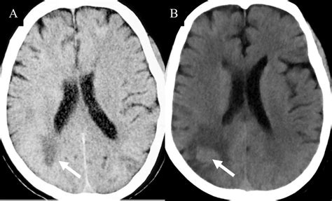 A Isodense Lesion White Arrow Were Detected On CT During An Early