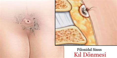 Kıl Dönmesi Pilonidal Sinus Neden Olur Belirtileri Nelerdir