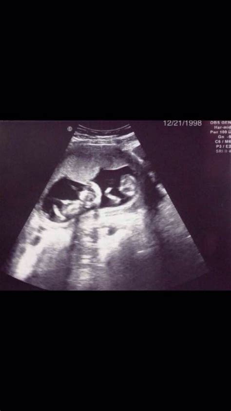 Girff And I Week Ultrasound Twins Ultrasound Fraternal Twins