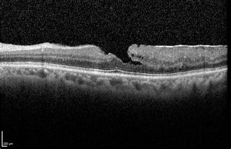 Agujero macular qué es Oftalvist