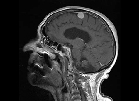 Zentrales Nervensystem Radiologie Herne Ihre Radiologen F R Offenes