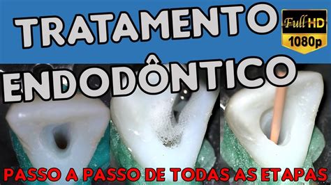 Passo A Passo Tratamento Endodontico BRAINCP